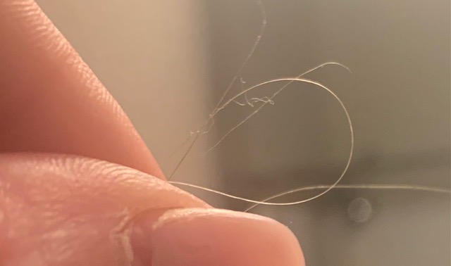 White, Hair-like Fibers Found All Over Body Causes Concern for This ...